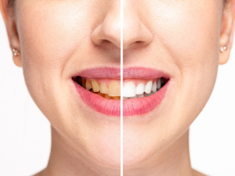 does brushing help yellow teeth