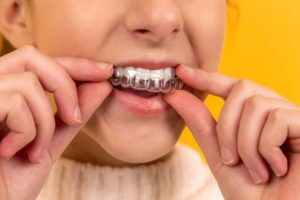 Dealing with Non-Tracking Teeth Aligners: Tips and Advice